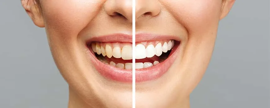 Permanent Teeth Whitening - Hospitadent