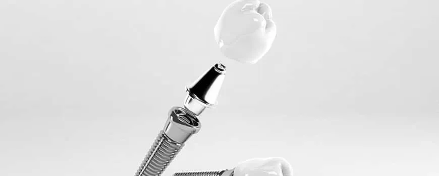 Types of Implants - Hospitadent