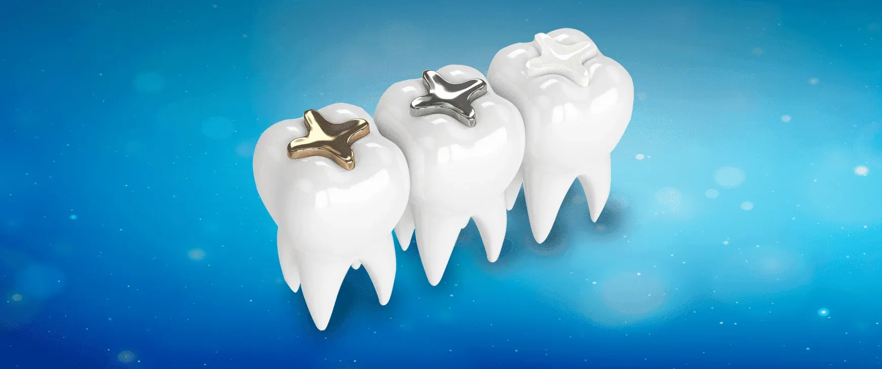 Aesthetic Tooth Filling - Hospitadent