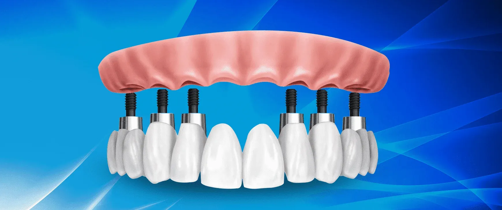 Qu’est-ce Qu’un Traitement par Implant Dentaire ? Comment est-il ...